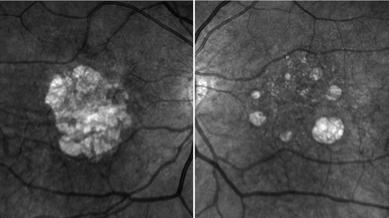 Gene Therapy for Retinal Disease | Ophthalmology Management