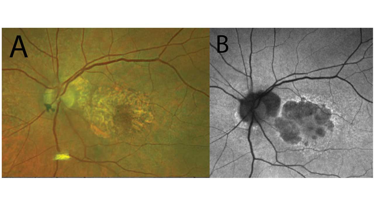 Latest in Retina Imaging | Ophthalmology Management