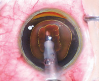 Ophthalmology Management | PentaVision