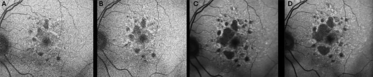 Rapid Developments in Geographic Atrophy | Ophthalmology Management