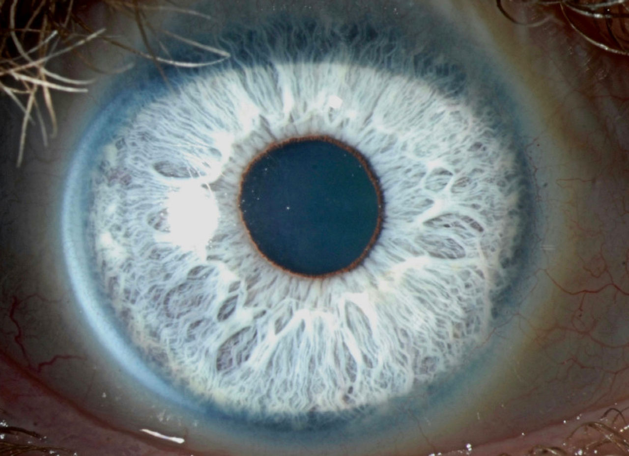 Medical and Surgical Management of Corneal Scarring | Ophthalmology ...