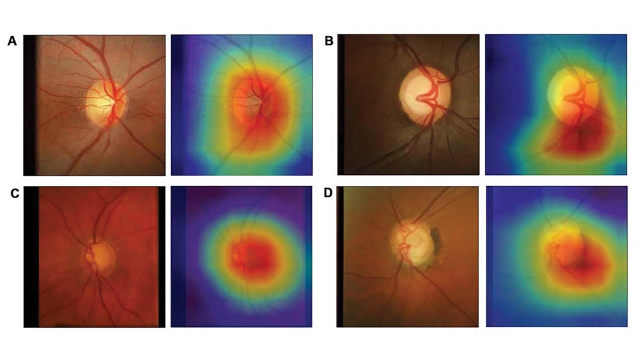 AI PROMISES TO TRANSFORM GLAUCOMA CARE | Ophthalmology Management
