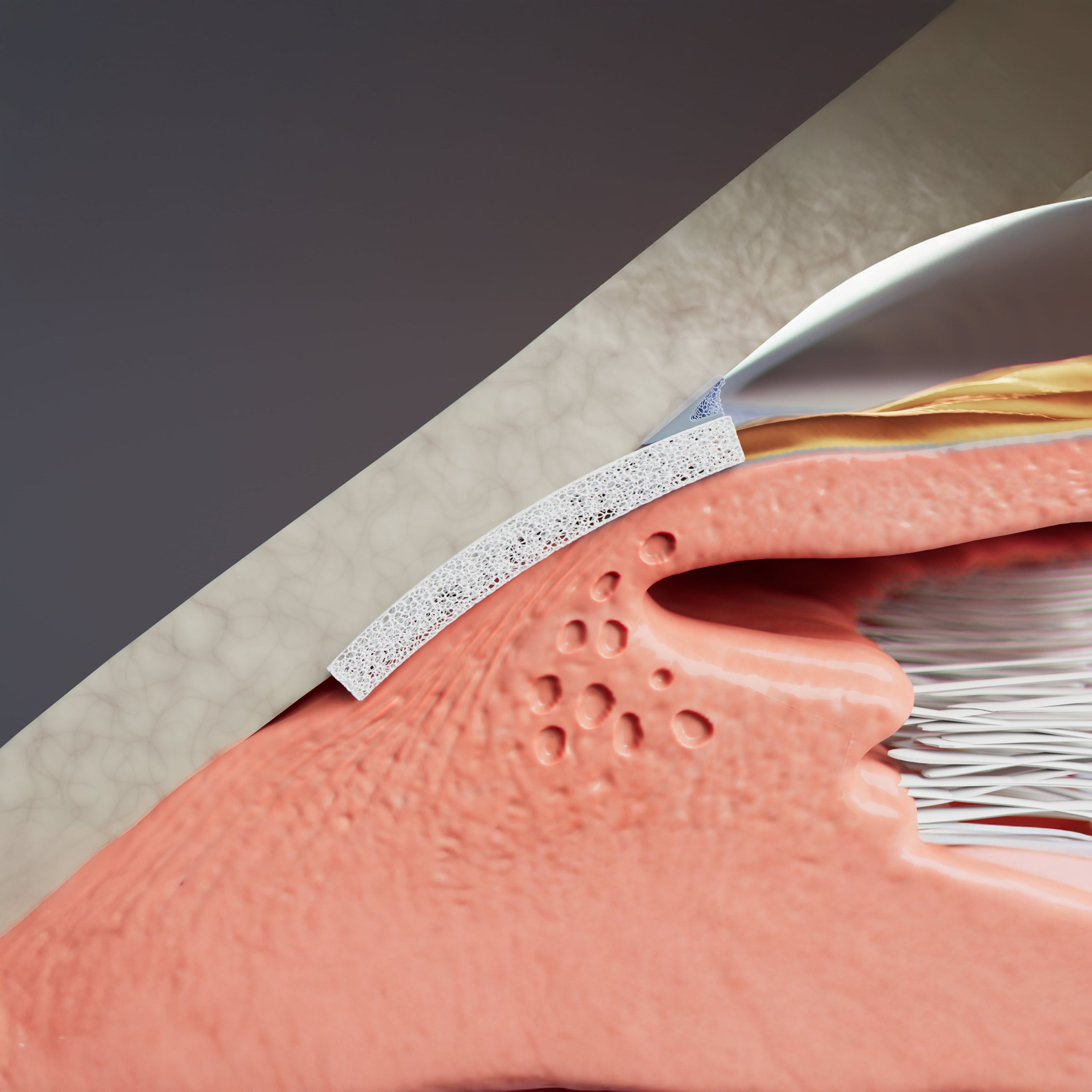 Dual-Outflow Surgery for Glaucoma | Ophthalmology Management